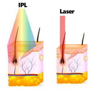 การทำ IPL คืออะไร? แตกต่างจากการทำ Laser อย่างไร? ลองมาดูกัน - PiOne